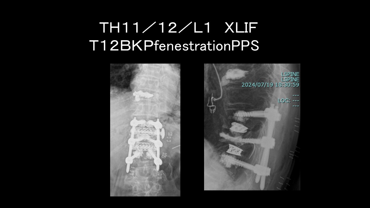 BKPで対応できない骨粗鬆症性椎体骨折とは？ ｜ 成尾整形外科病院
