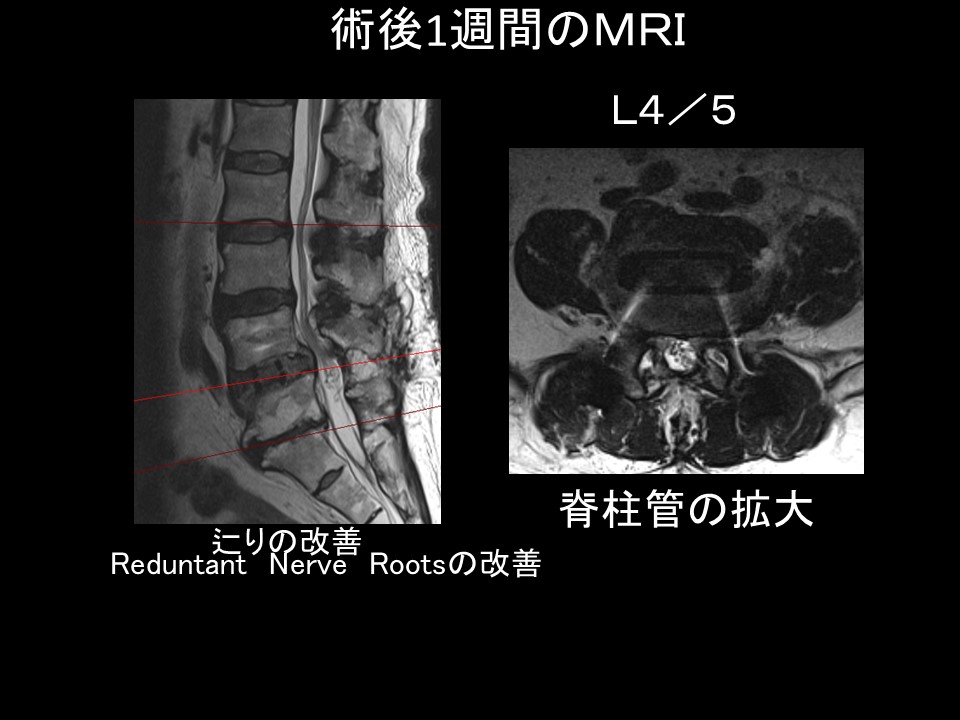 OLIF手術後の痛みを軽減！椎間関節ブロックの効果とその魅力 ｜ 成尾整形外科病院