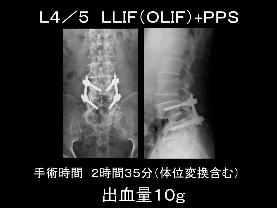 低侵襲脊椎手術、腰椎OLIF手術後のケージ沈下とは？―原因と予防法を専門医が徹底解説 ｜ 成尾整形外科病院