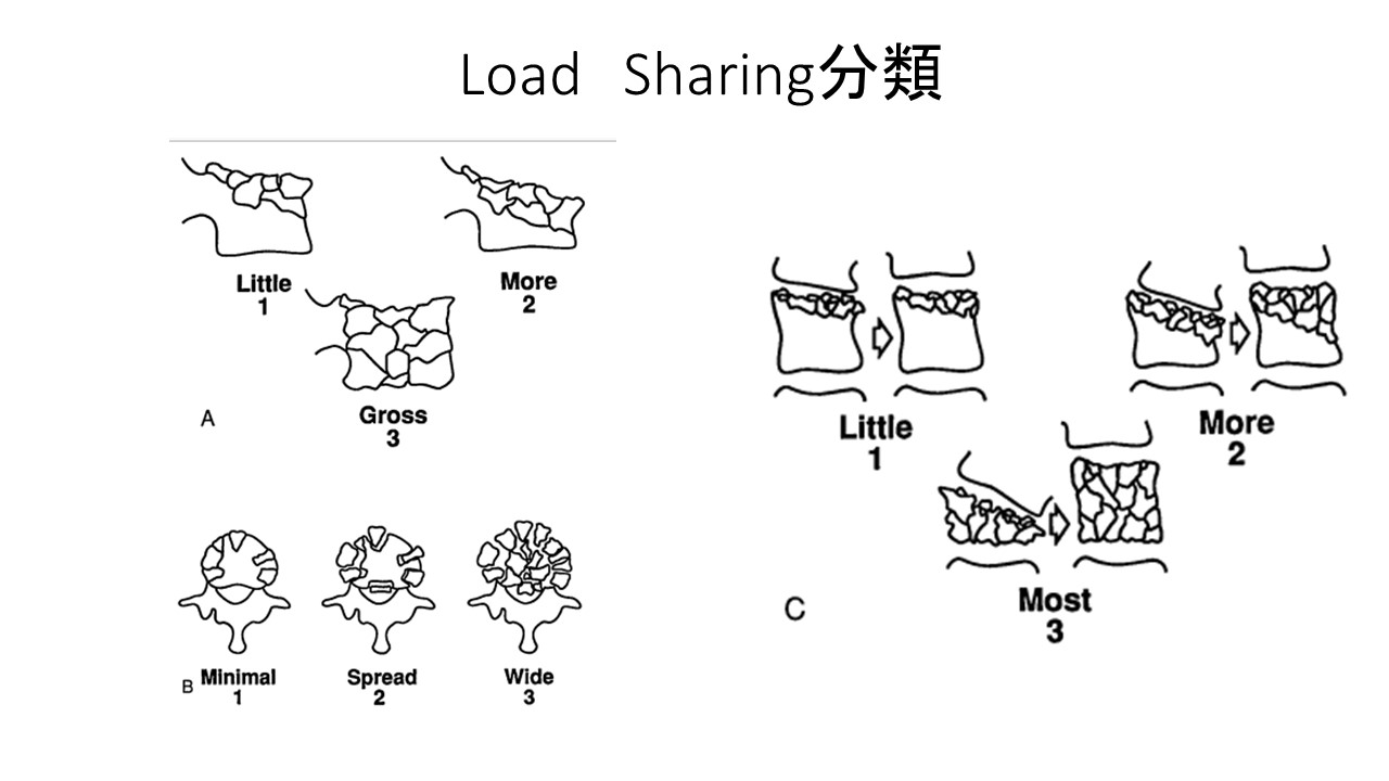 胸腰椎椎体骨折：前方再建術の重要性と最新治療法の解説 ｜ 成尾整形外科病院