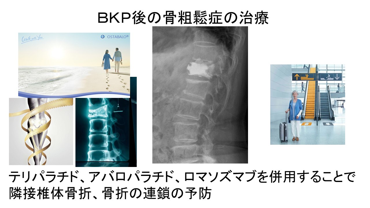 骨粗鬆症性椎体骨折の治療の発展：BKPで複数椎体手術が可能に！ ｜ 成尾整形外科病院