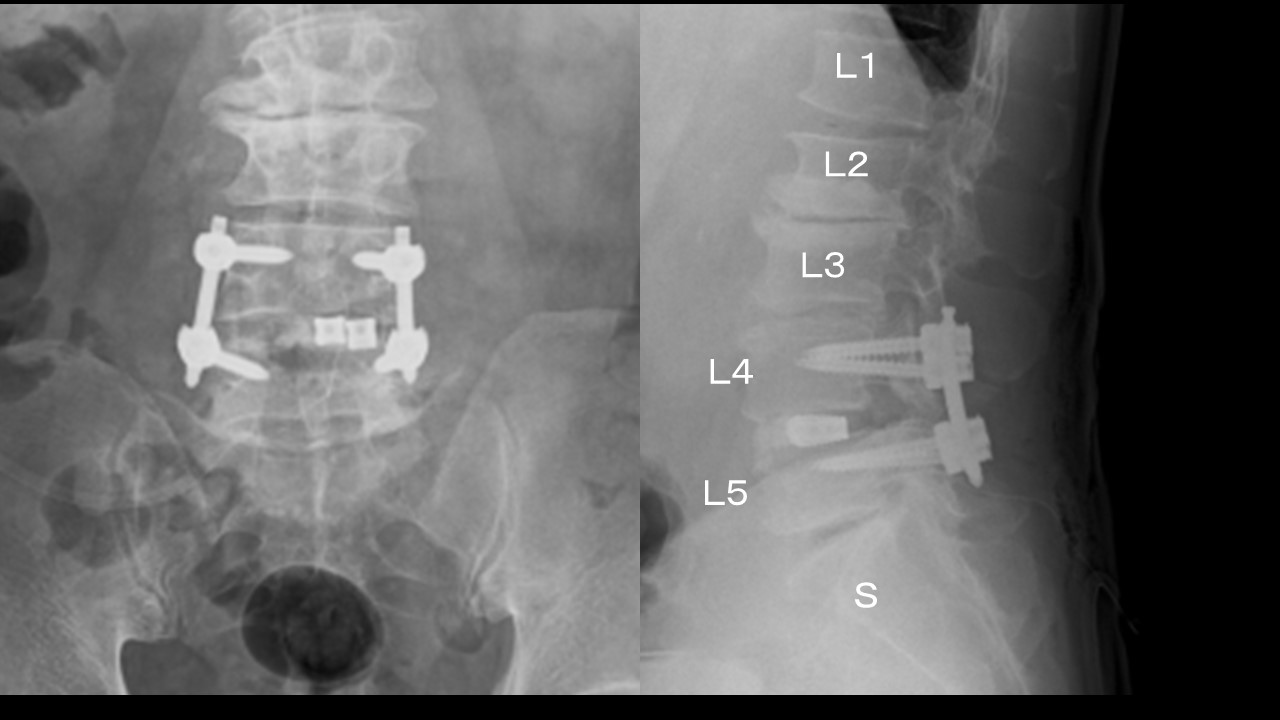 脊椎外科医が解説！L5-S1 TLIFは本当に再手術が多いのか？ ｜ 成尾整形外科病院