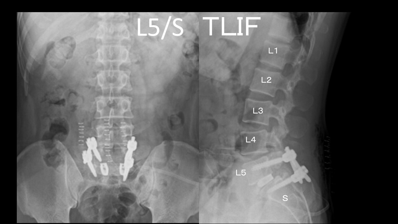 脊椎外科医が解説！L5-S1 TLIFは本当に再手術が多いのか？ ｜ 成尾整形外科病院